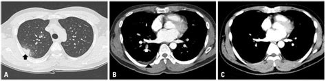 Chest Ct Of Patient A Chest Ct Demonstrates Wedge Shaped Peripheral