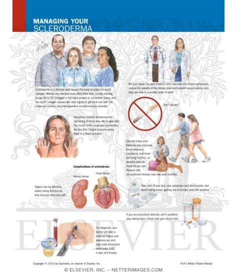 Managing Your Scleroderma