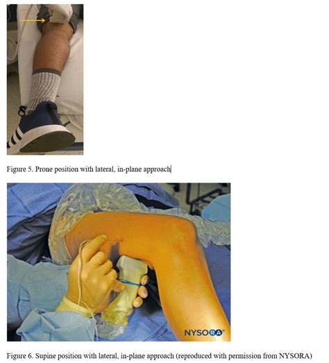 Popliteal Nerve Block Technique Prone Approach Supine