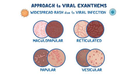 Approach To Viral Exanthems Pediatrics Video And Meaning Osmosis