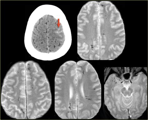The Radiology Assistant Epilepsy Role Of Mri