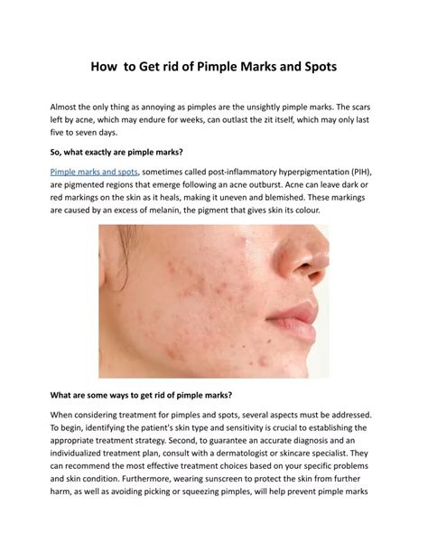 PPT How To Get Rid Of Pimple Marks And Spots PowerPoint Presentation ID