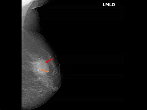 Atlas Of Breast Cancer Early Detection