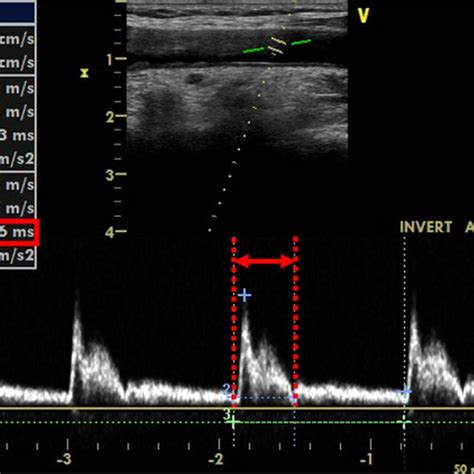 Carotid Doppler Waveform Red Arrow Indicates The Carotid Flow Time Download Scientific Diagram
