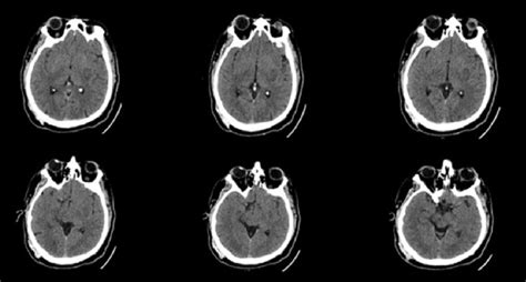 Computed Tomography Of The Skull Showing An Area Of Cortico Subcortical