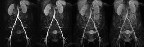 multiphase dynamic mrv in extensive pcs a arterial system b
