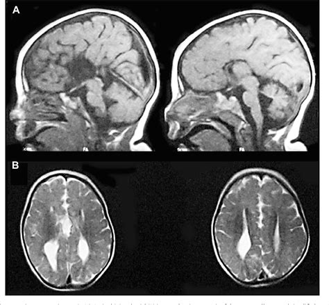 Figure 3 From Bladder Exstrophy And Extreme Genital Anomaly In A