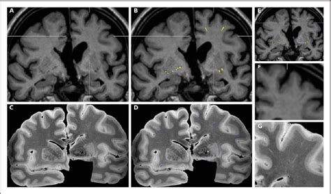 figure 1 from post mortem correlates of virchow robin spaces detected