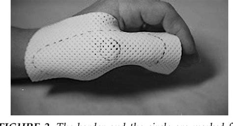 Figure 1 From A Functional Thumb Metacarpal Extension Blocking Splint Semantic Scholar