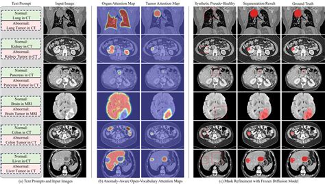 논문 리뷰 Advancing Generalizable Tumor Segmentation With Anomaly Aware