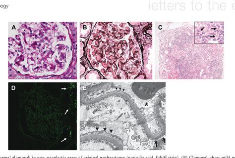Figure 1 From Nephrotic Syndrome Caused By The Angiogenesis Inhibitor Sorafenib Semantic Scholar