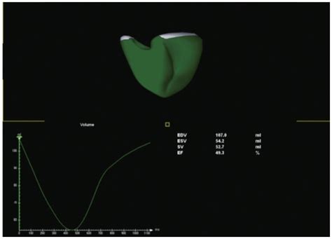 Right Ventricular RV Volume Measurement Using Real Time Dimensional Download Scientific