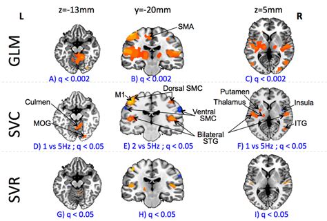 Similarities Between GLM SVC And SVR Statistical Brain Patterns It Is Download Scientific