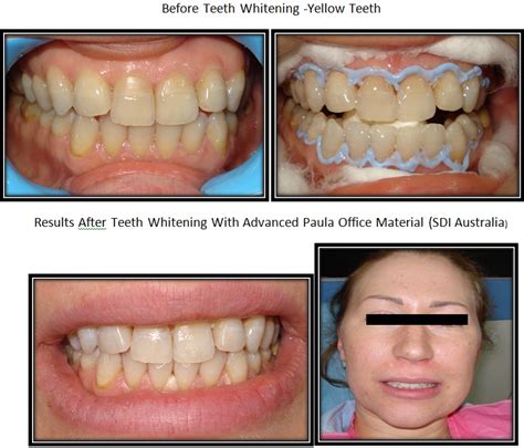 Dr Brijesh Patel Cosmetic Dentist Brij Dental Clinic And Implant