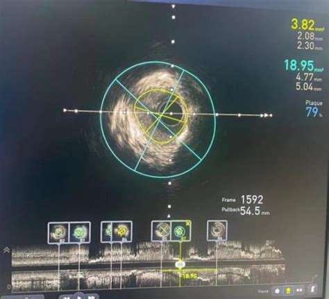 【医疗】我院心血管内科成功应用ivus为患者提供精准治疗 皖南医学院第二附属医院