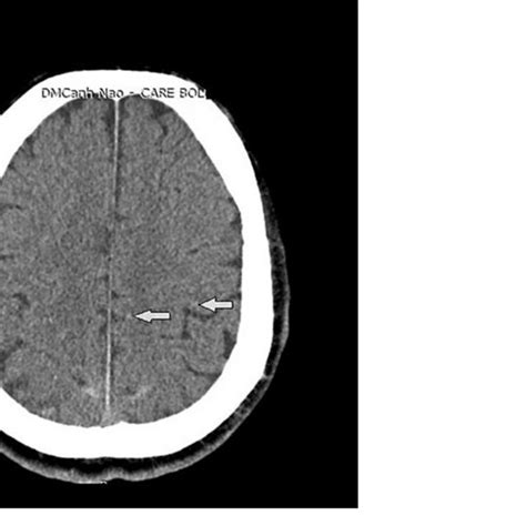 Non Enhanced Head Ct Scan Axial Slice Showing Hyperdense Parietal Download Scientific Diagram