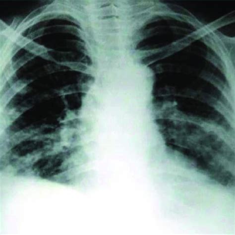 Chest X Ray From The Patient Showing Nodular Lesions Across Both Lungs Download Scientific