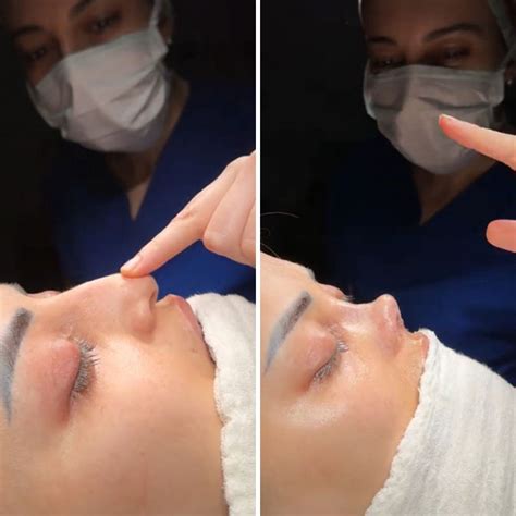 “she Had The Perfect Nose” Botched Nose Job Video Goes Viral Bored Panda