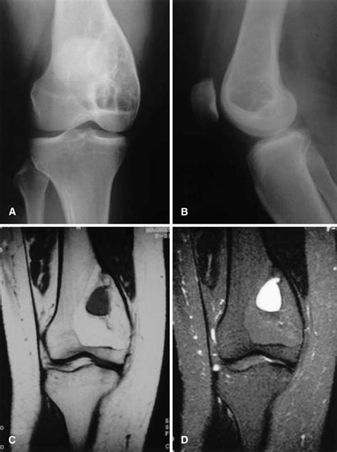 Anteroposterior A And Lateral B Radiographs Of A Biopsy Proven Download Scientific Diagram