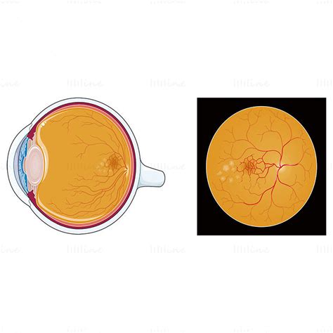 Macular Degeneration Vector Illustration