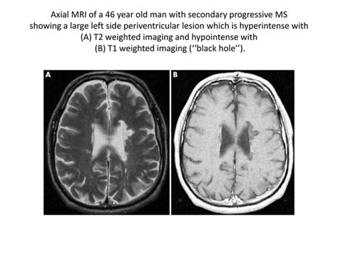 Radiology Of Multiple Sclerosis Pptx Radiology Of Multiple Sclerosis Pptx
