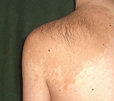 Melanocytic Nevi Beckers Nevus Perri Dermatology