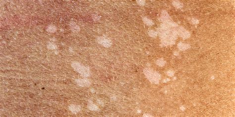Little White Scaly Spots On Skin