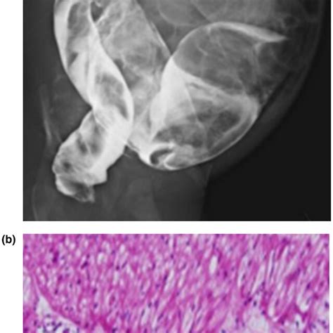 Aganglionic Bowel In Pt 8 A Barium Enema Study Showing The