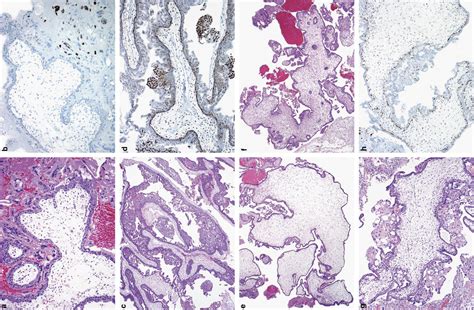 Characteristics Of Hydatidiform Moles Analysis Of A Prospective Series