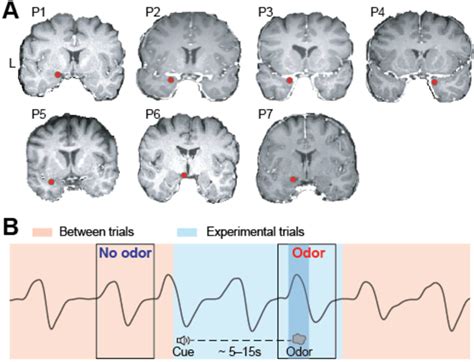 Figure 1 From Smell Induced Gamma Oscillations In Human Olfactory