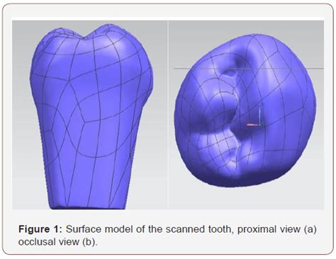 Influence Of Shoulder And Chamfer Margin Design On The Stress Distribution Pattern In Different