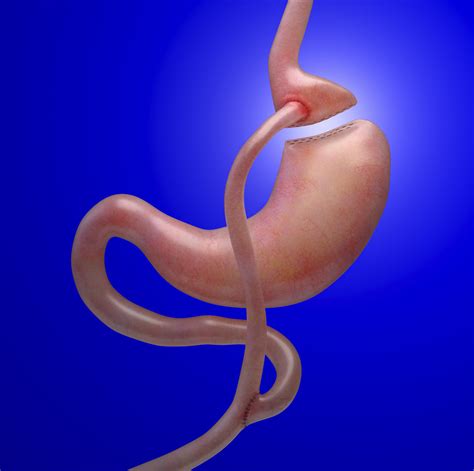 Gastric Bypass