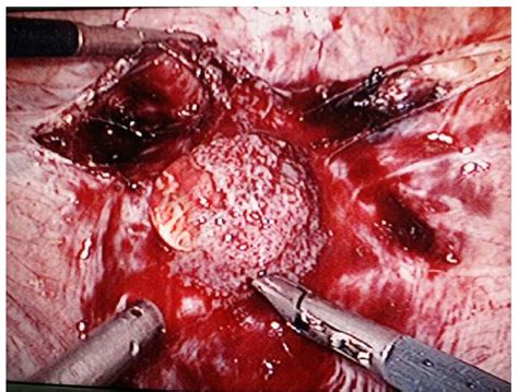 Opening Of The Bladder Peritoneum And Application Of The Pressure To
