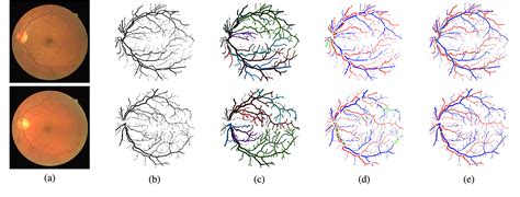 Figure 8 From Automated Method For Retinal Arteryvein Separation Via