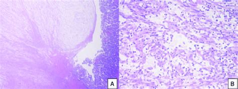 A A Low Power View Of The Polypoid Lesion Left And The Adjacent
