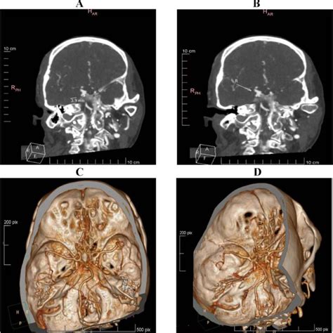 Ct Head Enhanced Scan Of Patients A And B Ct Head C And D Ct
