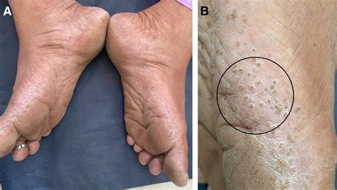 Keratoderma Climactericum