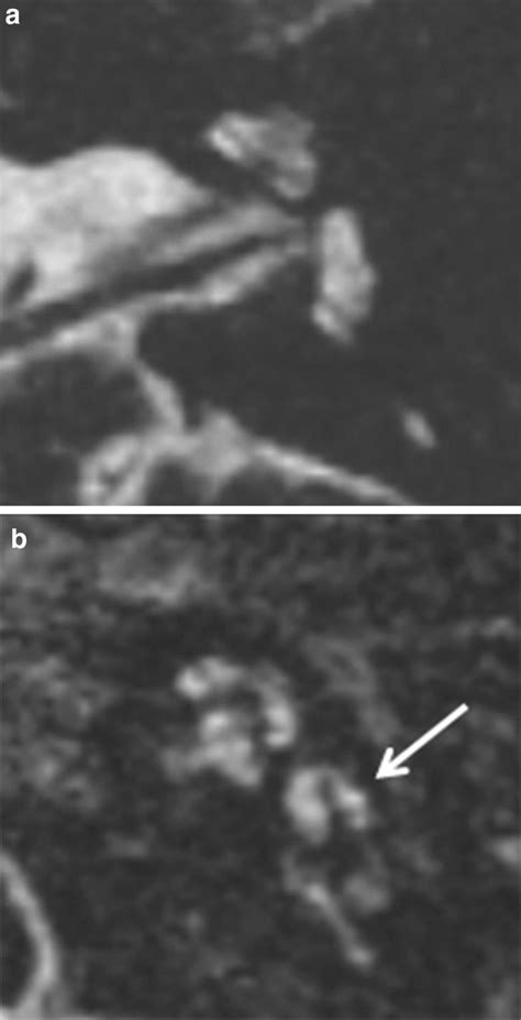 Axial T2w Gradient Echo Fiesta C Mri Centred On The Ow A Normal Ow On Download Scientific