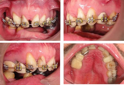 Post Alignment Intra Oral Photographs Download Scientific Diagram