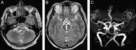 Figure 1 From Vascular Compression Of Multiple Cranial Nerves