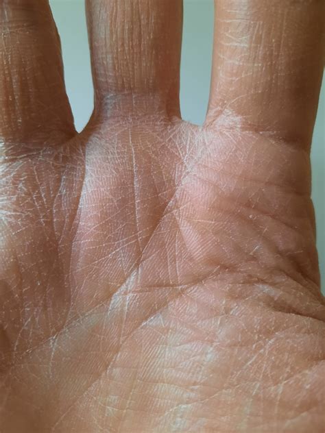 This Ia How My Hands Look Like When Im On Break From Antihydral After Using It For One Week