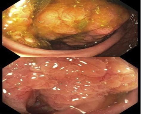 Official Journal Of The American College Of Gastroenterology Acg