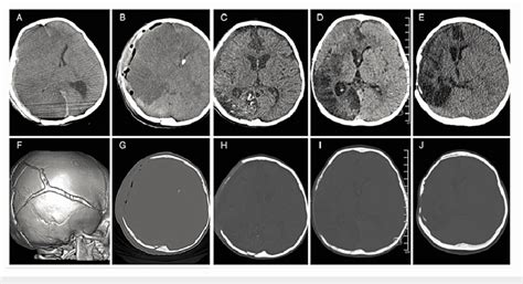 Non Contrast Head Cts At Successive Time Intervals Pre And Post Middle Download Scientific