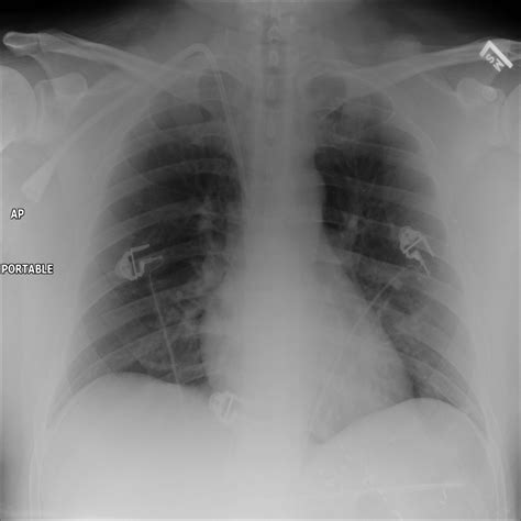 Features Atelectasis Instance Segmentation Dataset By Rayproject