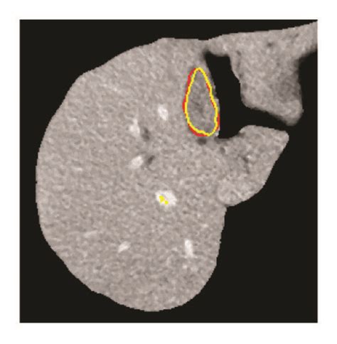 Comparisons Between Tumor Segmentation Results And Ground Truth Yellow