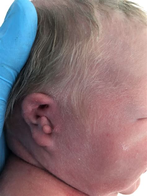 What Causes Malformed Ears