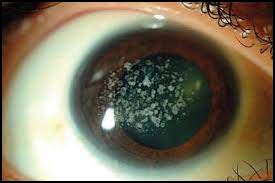 Herbal Remedies For Amyloid Corneal Degeneration