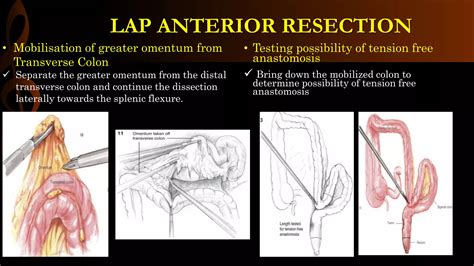 Lap Anterior Resection Step By Step Operative Surgerypptx