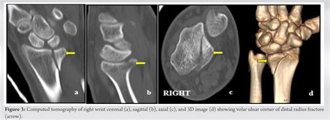 Bilateral Avulsion Fractures Of Extensor Carpi Ulnaris A Case Report Journal Of Orthopaedic