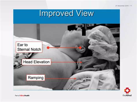 Airway In Trauma Jk Pui Pptx First Aid Injuries